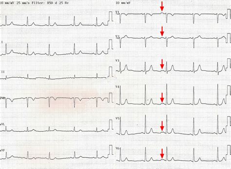 Interatrial Block Ecg Book