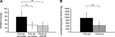 Clinical Motor Outcome Of Bilateral Subthalamic Nucleus Deep