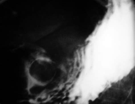 Gall Bladder Gallstone Ileus 2510 Gallstones Choledochoduodenal