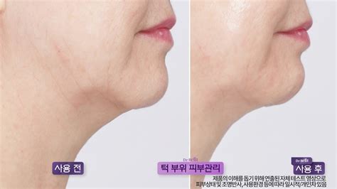 닥터리핏 콜라겐100 당김실 리프팅 앰플이중턱 주름개선 Youtube