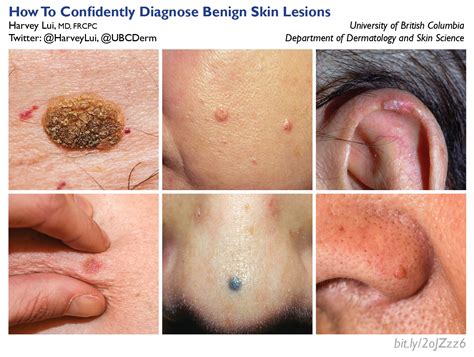 Overview Of Benign Skin Lesions Common Lesions And Management Ydcisn