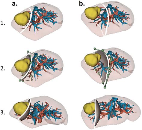 Virtual Resection Planning Steps 1 Positioning A Resection Line And A