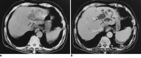 A 68 Year Old Man With Cholangiocarcinoma Associated With Download Scientific Diagram