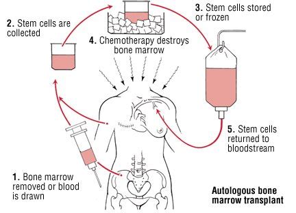 Multiple Sclerosis Research Bone Marrow Transplantation Bmt