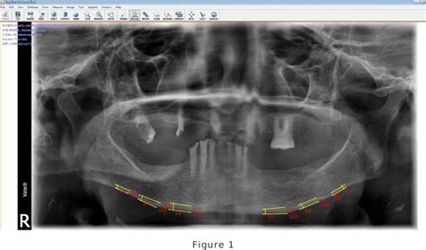 Figure 1 From Evaluation Of Mandibular Inferior Cortical Bone Thickness