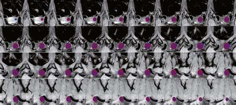 A Deep Learning Framework For Intracranial Aneurysms Automatic Segmentation And Detection On