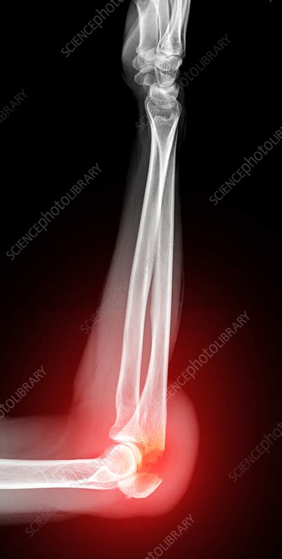 Elbow Fracture X Ray Stock Image F0460164 Science Photo Library