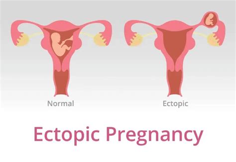 What Is Ectopic Pregnancy Symptoms Test Causes