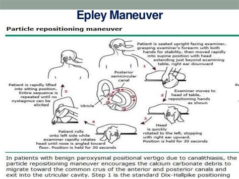 Epley Maneuver Bppv