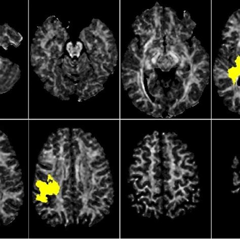 Modeling Of Anisotropic Brain Tumor Grow During Time Download Scientific Diagram