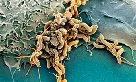 Campylobacteriosis Symptoms Causes Treatment