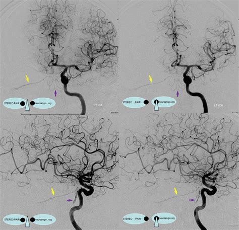 Meningohypophyseal Trunk