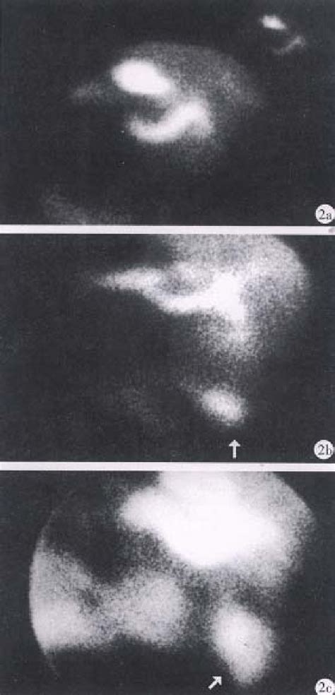 Intestinal Content Reflux After An Intravenous Injection Of 99 Download Scientific Diagram