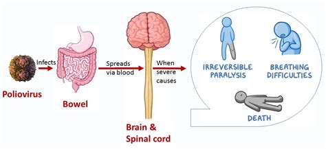 Poliomyelitis What Africans Need To Know