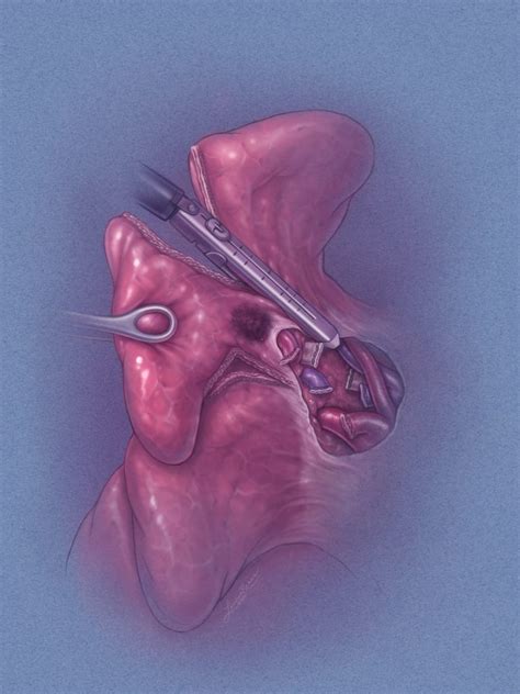 Lung Segmentectomy Lauren Rakes