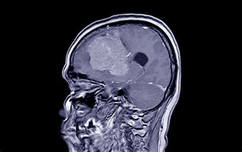 Cerebral Edema Concept Over 37 Royalty Free Licensable Stock Photos Shutterstock