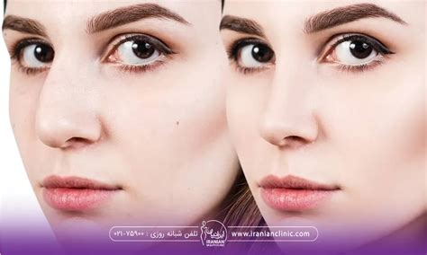 عمل بینی گوشتی چیست، عوارض و هزینه آن