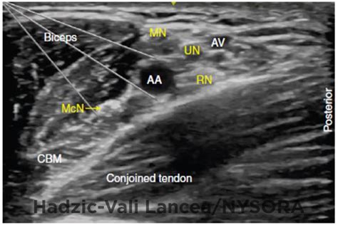 Ultrasound Guided Axillary Brachial Plexus Block Nysora The New York School Of Regional Anesthesia