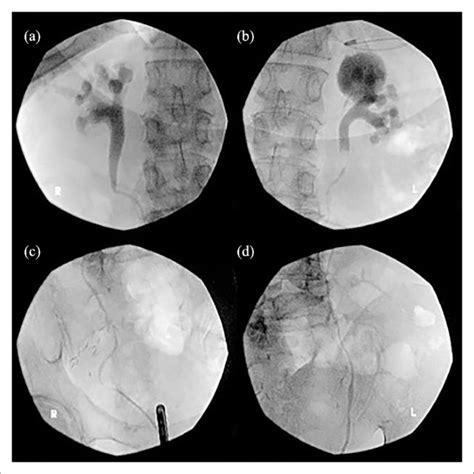 Bilateral Retrograde Pyelogram Rpg On Fluoroscopy A And B Download Scientific Diagram