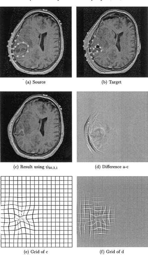 Figure 4 From Radial Basis Functions With Compact Support For Elastic Registration Of Medical