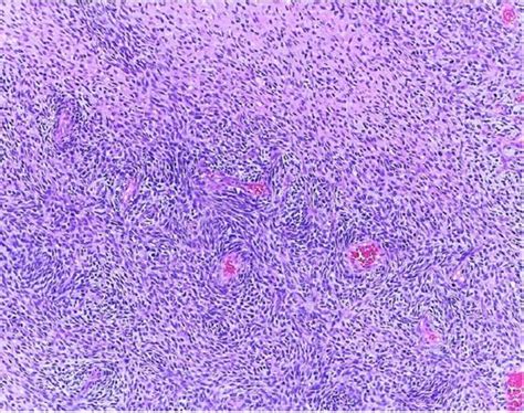 Fascicles Of Spindle Shaped Cells With Varying Cellularity And