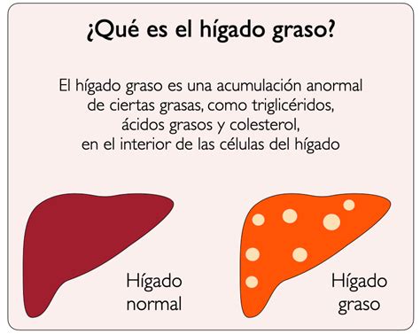 Artículo Todo Lo Que Necesita Saber Sobre El Hígado Graso Farmacia