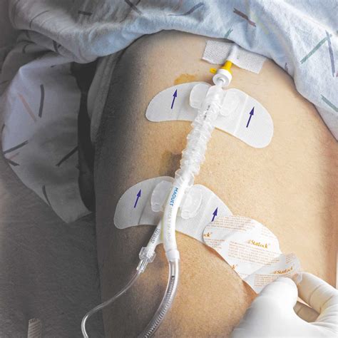 Statlock Iab Stabilization Device Getinge