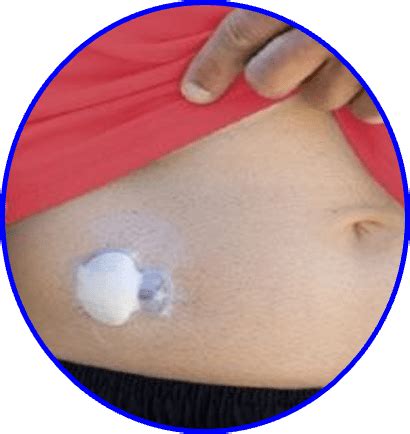 Changing Your Sensor Sensor And Transmitter Support Medtronic