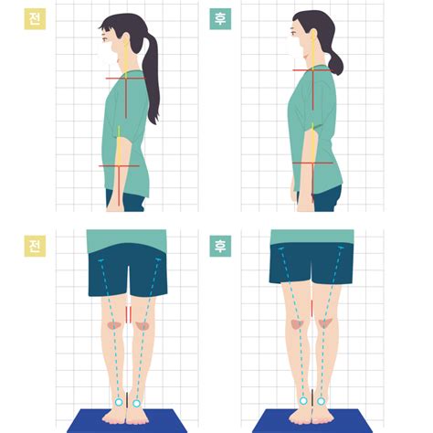 자세교정사례 1 페이지 키네스 Kiness
