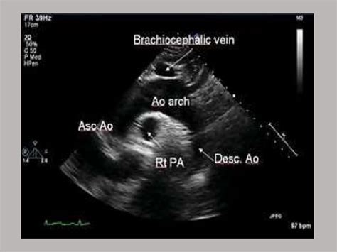 How To Read Echocardiography Of Heart Pptx