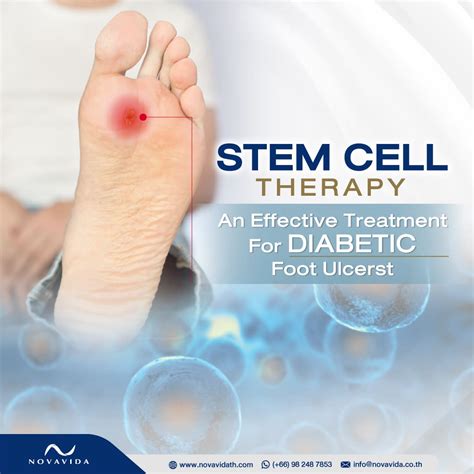 Treatment For Diabetic Ulcers On The Foot Sale Online