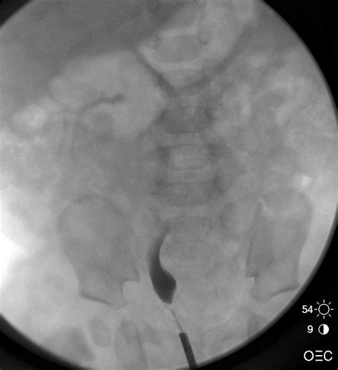 Retrograde Pyelogram Done During Surgery Vyjsbi