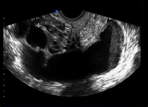 Pelvic Inflammatory Disease PID Reproductive Medbullets Step 1