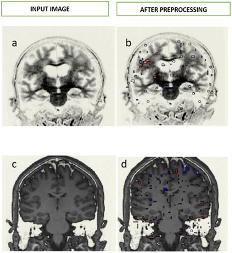 Frontiers Early Detection Of Alzheimers Disease In Structural And