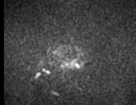 Project Aimi Dwi Object Detection Dataset By Dwi Bleed Detection