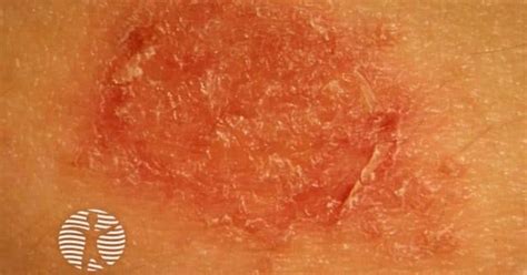 Nummular Dermatitis Discoid Eczema Image