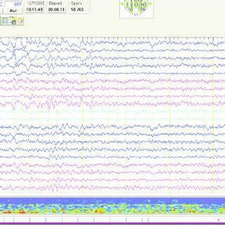 Left Temporal Sharp Waves Download Scientific Diagram