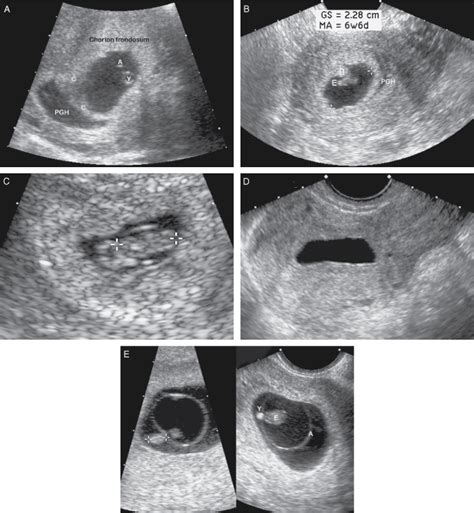 Early Pregnancy Ultrasound