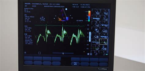 Understanding The Echocardiogram Procedure Benefits And Insights