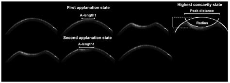 The Entire Process Of Corneal Deformation By Airflow Used In Corvis St