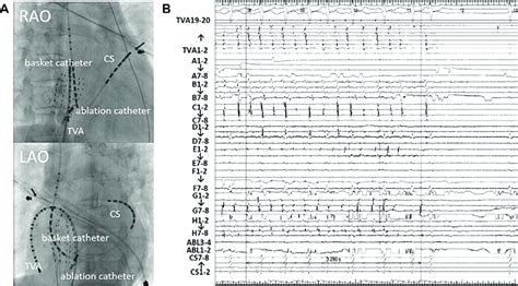 A Successful Radiofrequency Application And Catheter Positions B Download Scientific Diagram