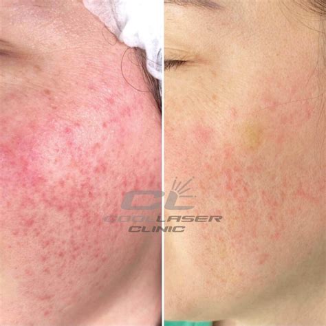 Удаление азотом рубцов и шрамов в Киеве - Coolaser Clinic