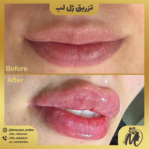 ژل لب دکتر مریم ایزدیان