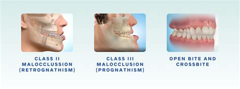 Understanding The Differences Between Skeletal Malocclusion And Dental Malocclusion In