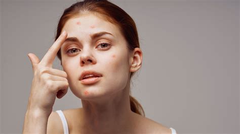 Differin Acne Treatment Gel Growing Apex