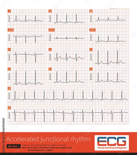 the retrograde p wave of the inferior leads can come from the lower