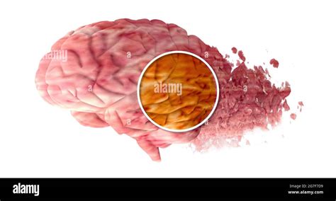 Memory Lapses Forgetting Things Degenerative Disease Brain Problems