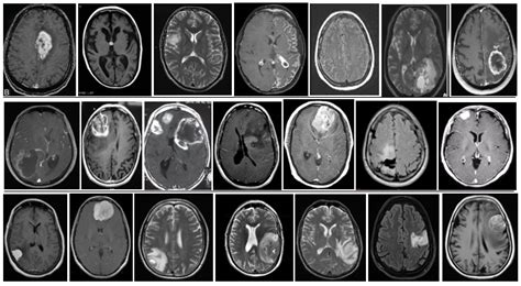 Applied Sciences Free Full Text A Novel Data Augmentation Based Brain Tumor Detection Using