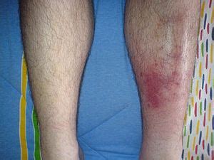Cellulitis Wikipedia