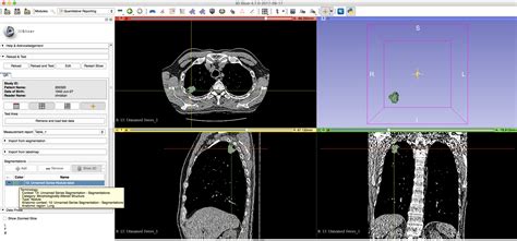 Anatomic Region Modifier Is Not Displayed In Terminology Tooltip · Issue 199 · Qiicr
